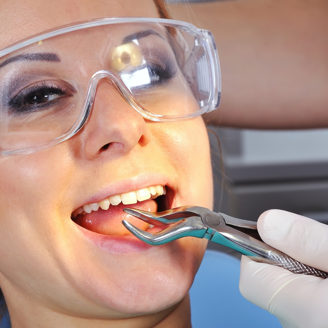 How to Prepare for Wisdom Teeth Surgery? - West Five Family Dental